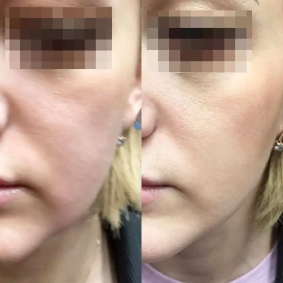 Best Fat Dissolving Shots: How to Choose (And Our Top Picks) | meamo