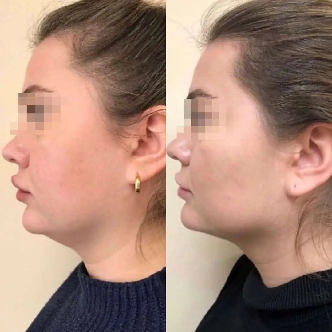 Best Fat Dissolving Shots: How to Choose (And Our Top Picks) | meamo